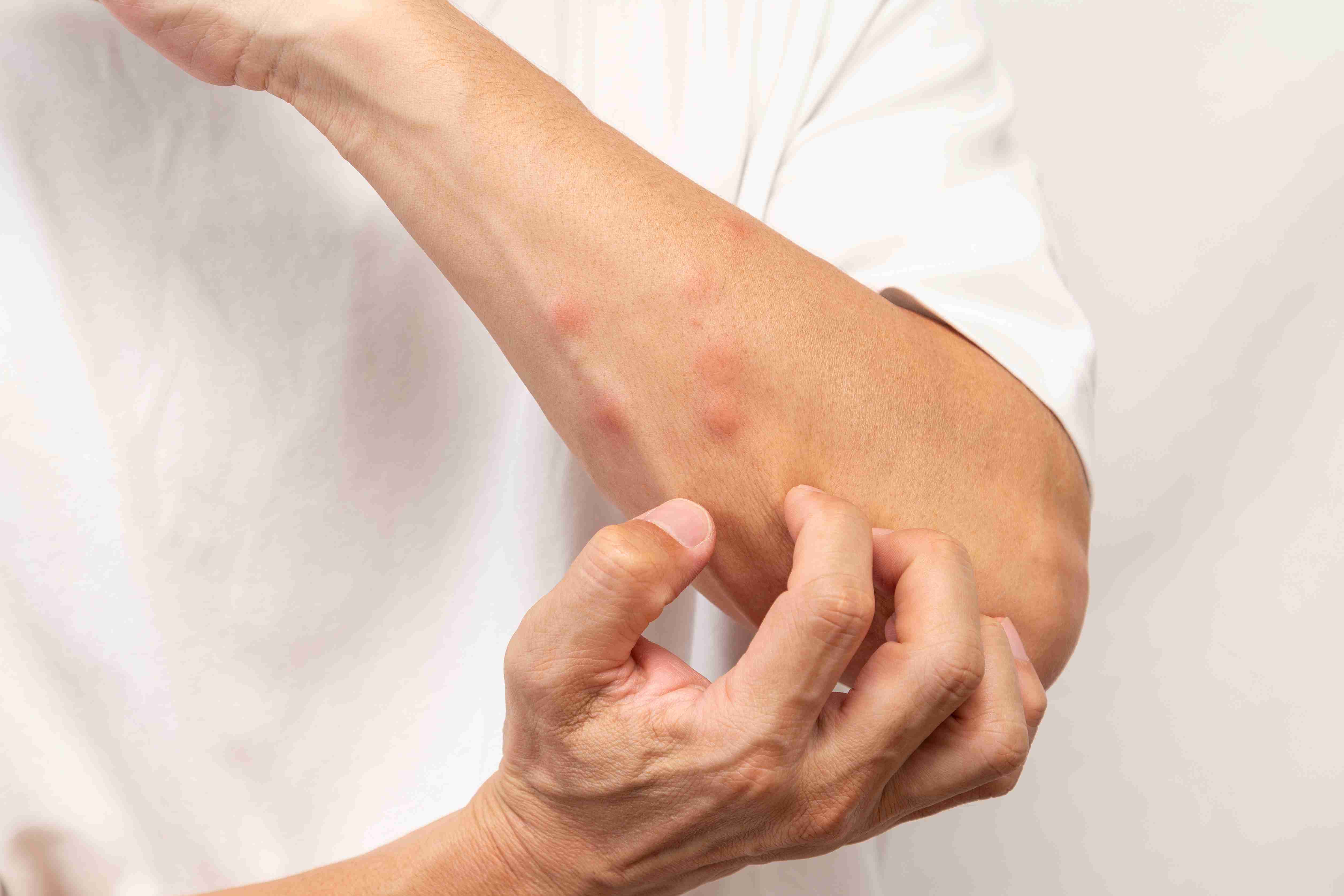 A Must-Read for Those Staying in Japan! What Are Effective Mosquito ...